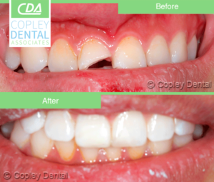CASE 28: Broken Or Fractured Tooth - Copley Dental